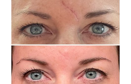 FlattenU | Repair All Types Scars | Long-term Result