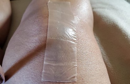 FlattenU | Repair All Types Scars | Long-term Result